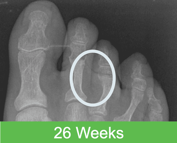 OSSIOfiber® Hammertoe Fixation System