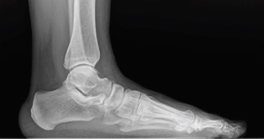 Metal-Free Bunion Correction: OSSIOfiber® Trimmable Nails & Scarf ...