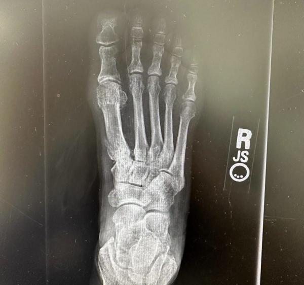 OSSIO – Naturally Transformative Bone Healing