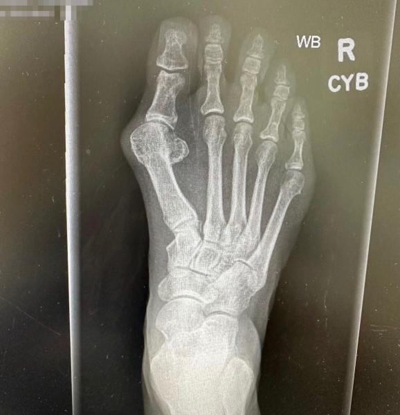 OSSIO – Naturally Transformative Bone Healing