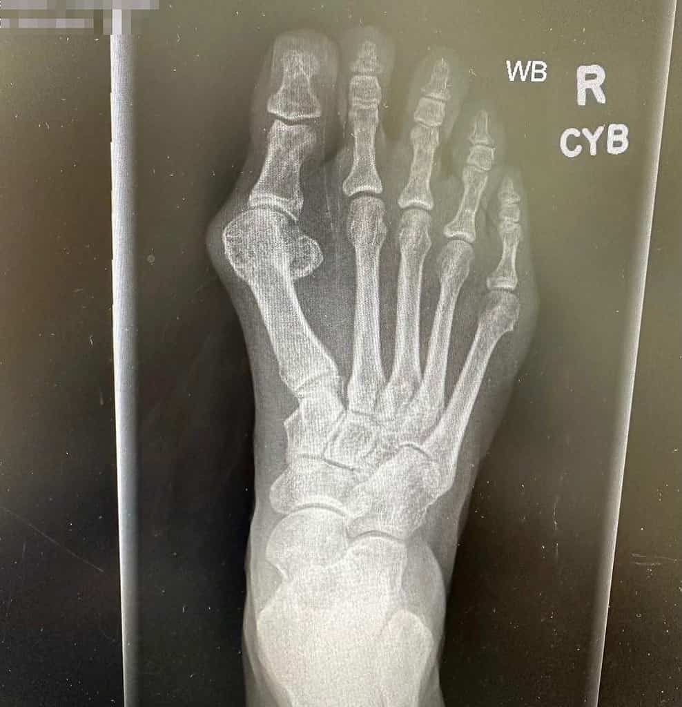 OSSIO – Naturally Transformative Bone Healing