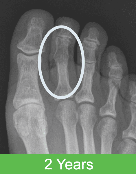 OSSIOfiber® Hammertoe Fixation System