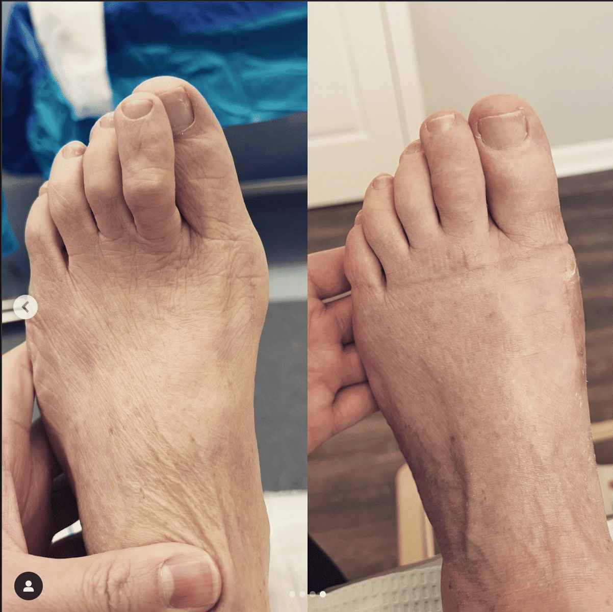 OSSIOfiber® - A Metal-Free Solution For Your Feet