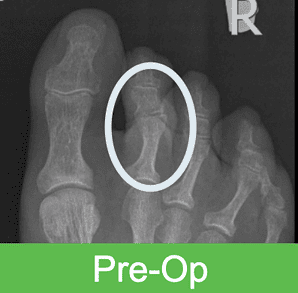 OSSIOfiber® Hammertoe Fixation System