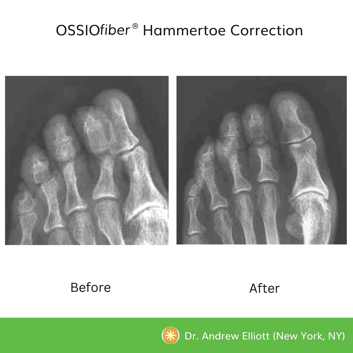 What is a Hammertoe? Symptoms, Causes & Metal-Free Treatment