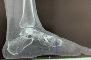Midfoot Revision Arthrodesis: OSSIOfiber® Nail & Screws