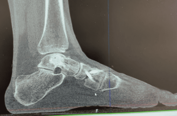 Midfoot Revision Arthrodesis: OSSIOfiber® Nail & Screws