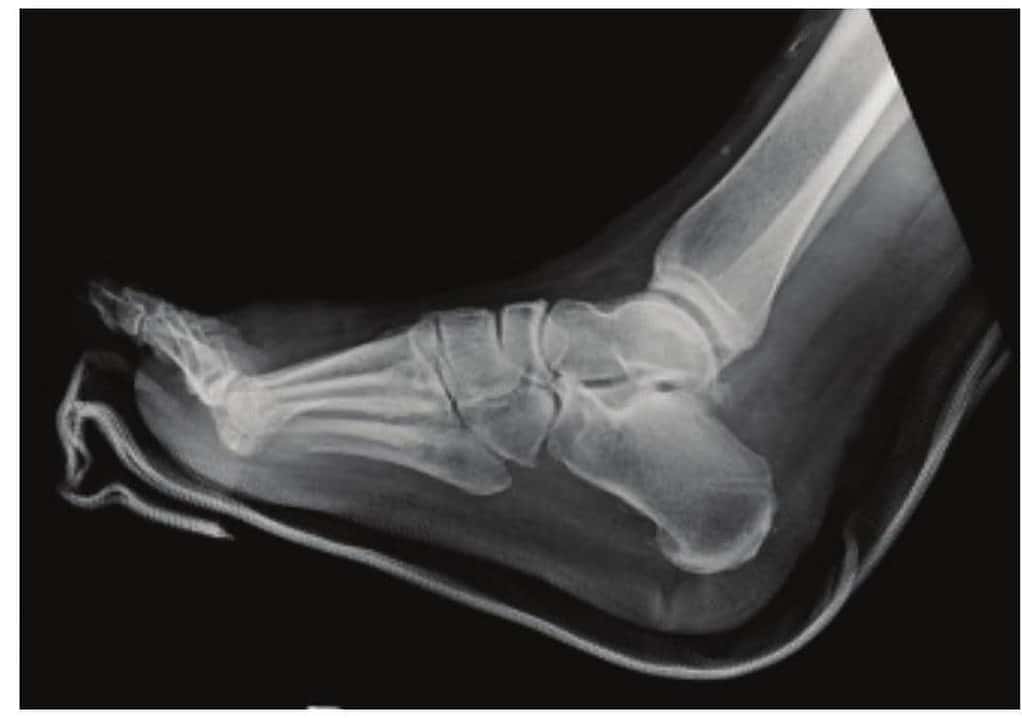 All-Natural Suture Anchor for Retrocalcaneal Enthesopathy