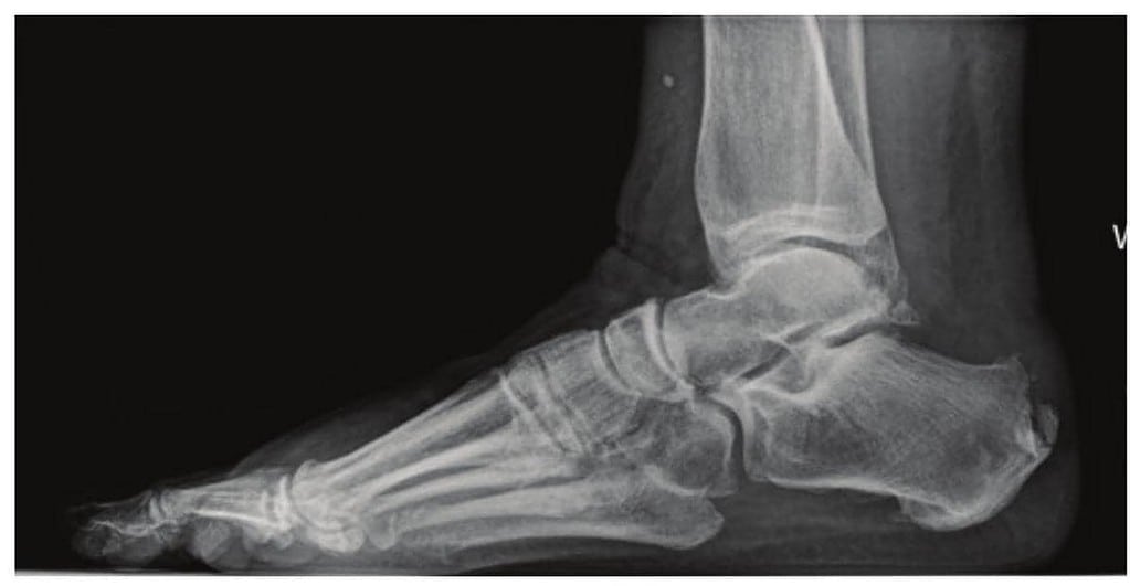 The Use of an All Natural OSSIO® Suture Anchor in the Treatment of a ...