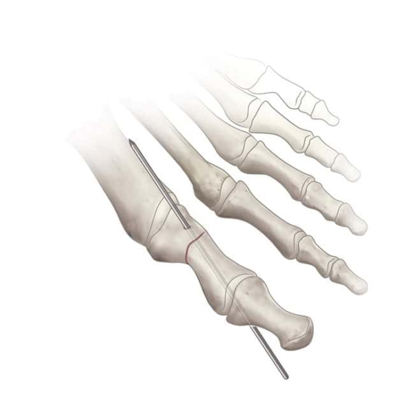 OSSIOfiber® Bio-Integrative Metal-Free Compression Staples