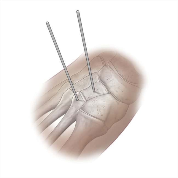 OSSIOfiber® Bio-Integrative Metal-Free Compression Staples