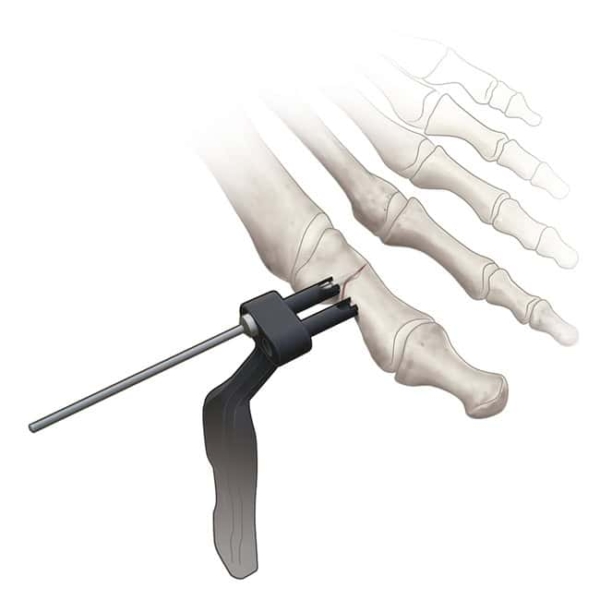 OSSIOfiber® Bio-Integrative Metal-Free Compression Staples