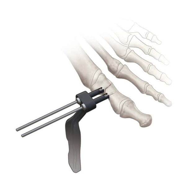 OSSIOfiber® Bio-Integrative Metal-Free Compression Staples