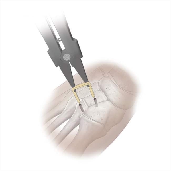 OSSIOfiber® Bio-Integrative Metal-Free Compression Staples