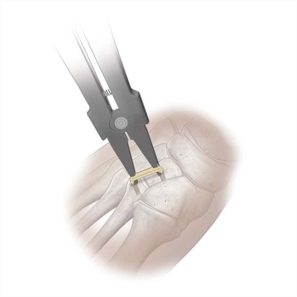 OSSIOfiber® Bio-Integrative Metal-Free Compression Staples