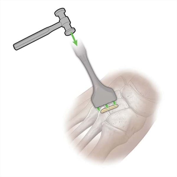 OSSIOfiber® Bio-Integrative Metal-Free Compression Staples