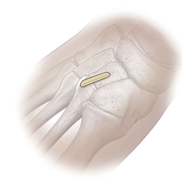 OSSIOfiber® Bio-Integrative Metal-Free Compression Staples