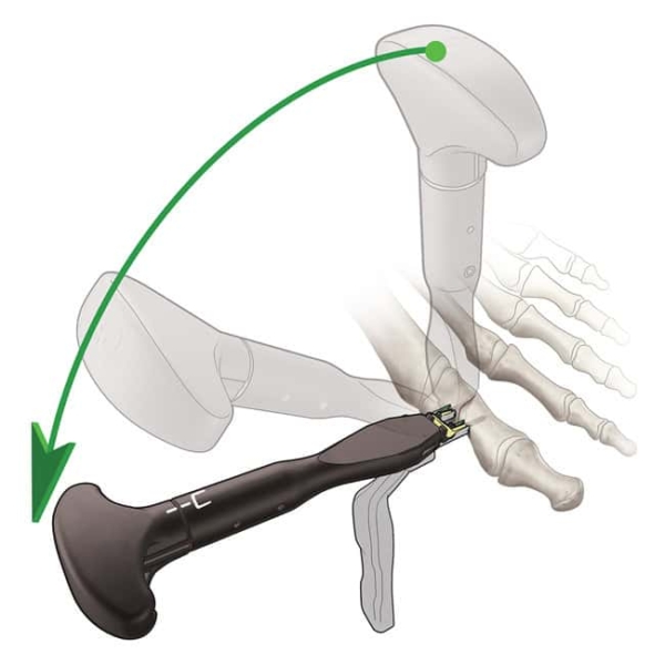 OSSIOfiber® Bio-Integrative Metal-Free Compression Staples