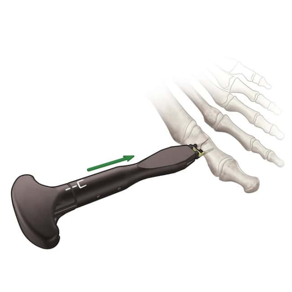 OSSIOfiber® Bio-Integrative Metal-Free Compression Staples