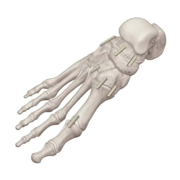 OSSIOfiber® Bio-Integrative Metal-Free Compression Staples