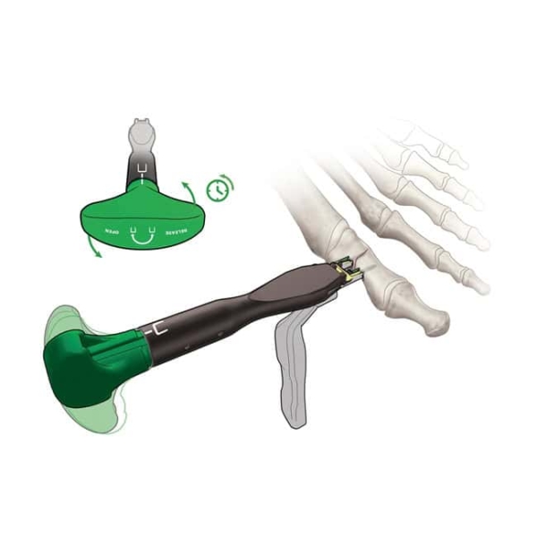 OSSIOfiber® Bio-Integrative Metal-Free Compression Staples