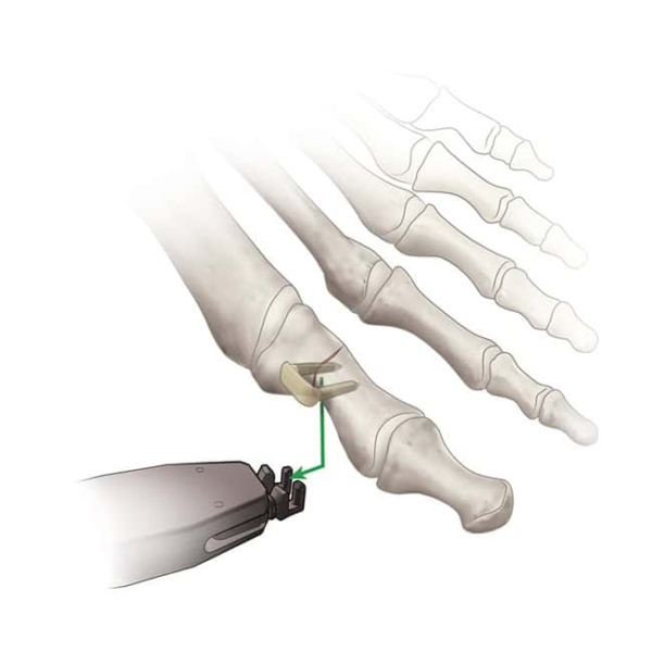 OSSIOfiber® Bio-Integrative Metal-Free Compression Staples