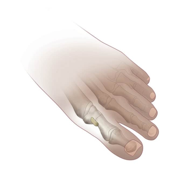 OSSIOfiber® Bio-Integrative Metal-Free Compression Staples