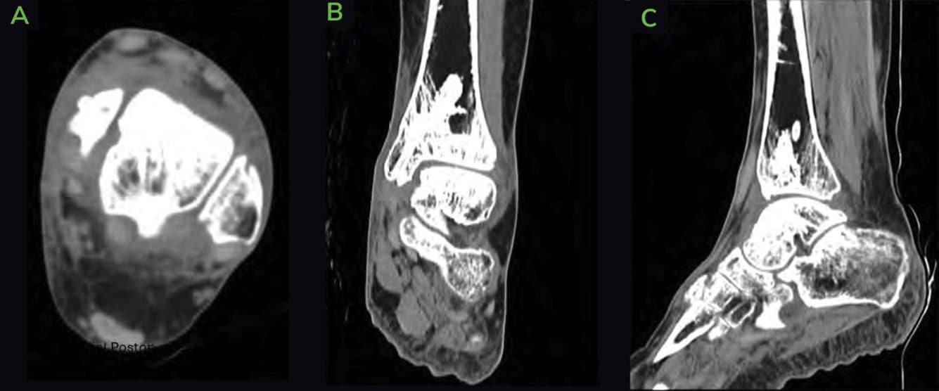 Using Bio-integrative Implants for the Fixation of Allograft ...