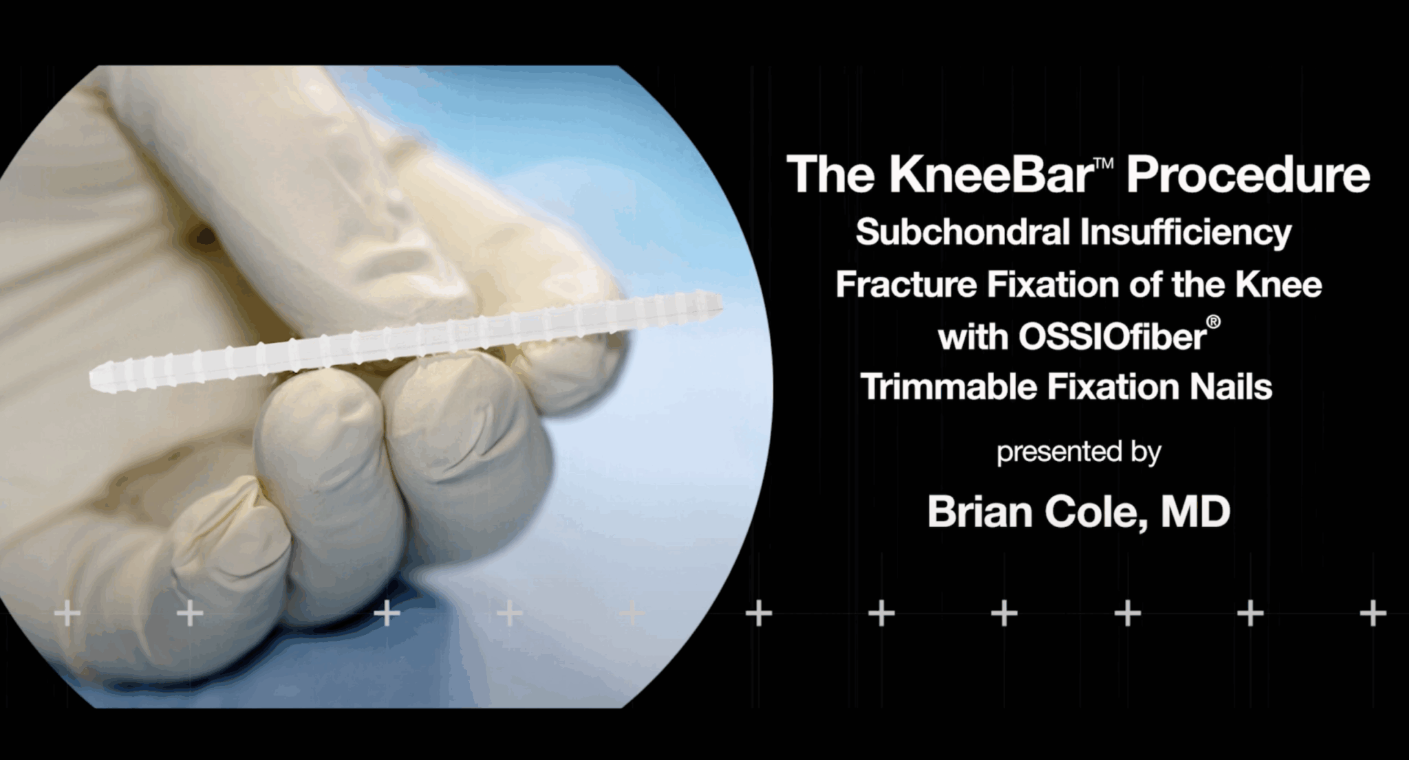 KneeBar® Procedure - OSSIO – Naturally Transformative Bone Healing