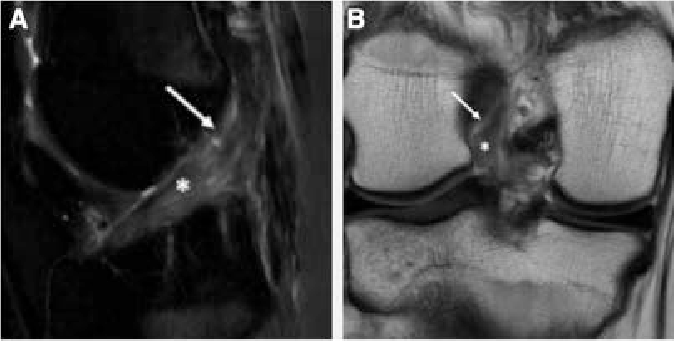 Primary Arthroscopic Repair of Chronic Anterior Cruciate Ligament Tears